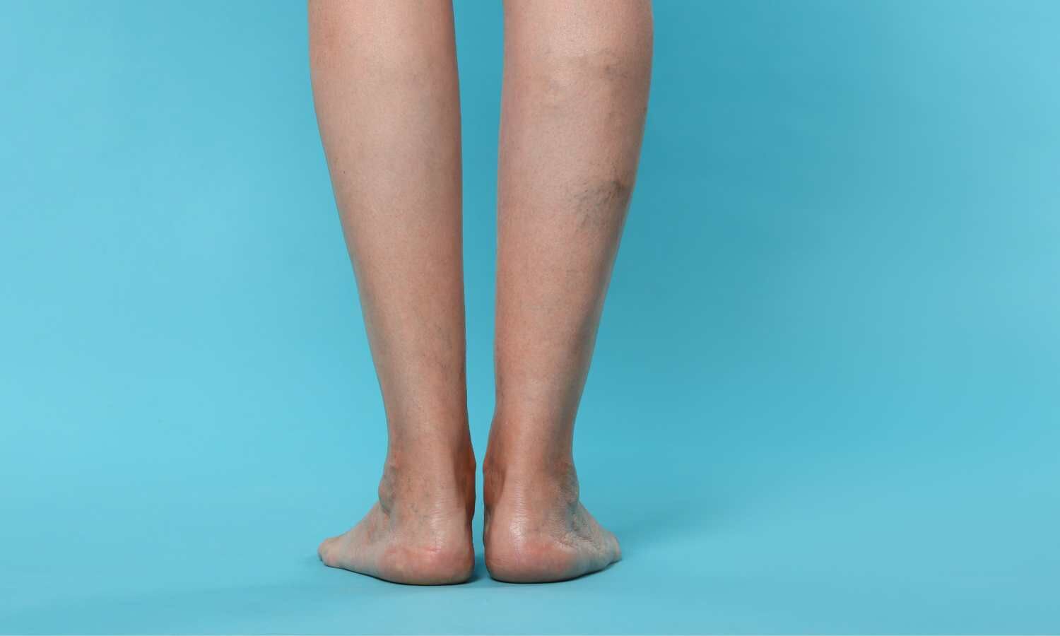Long Covid may present with 'blue legs' symptom: Lancet