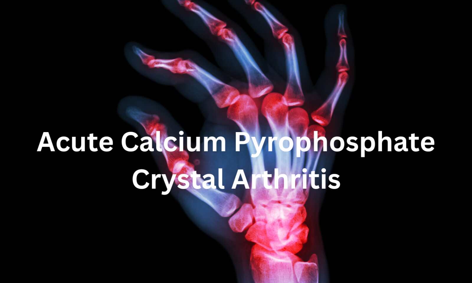 Calcium Pyrophosphate Crystals
