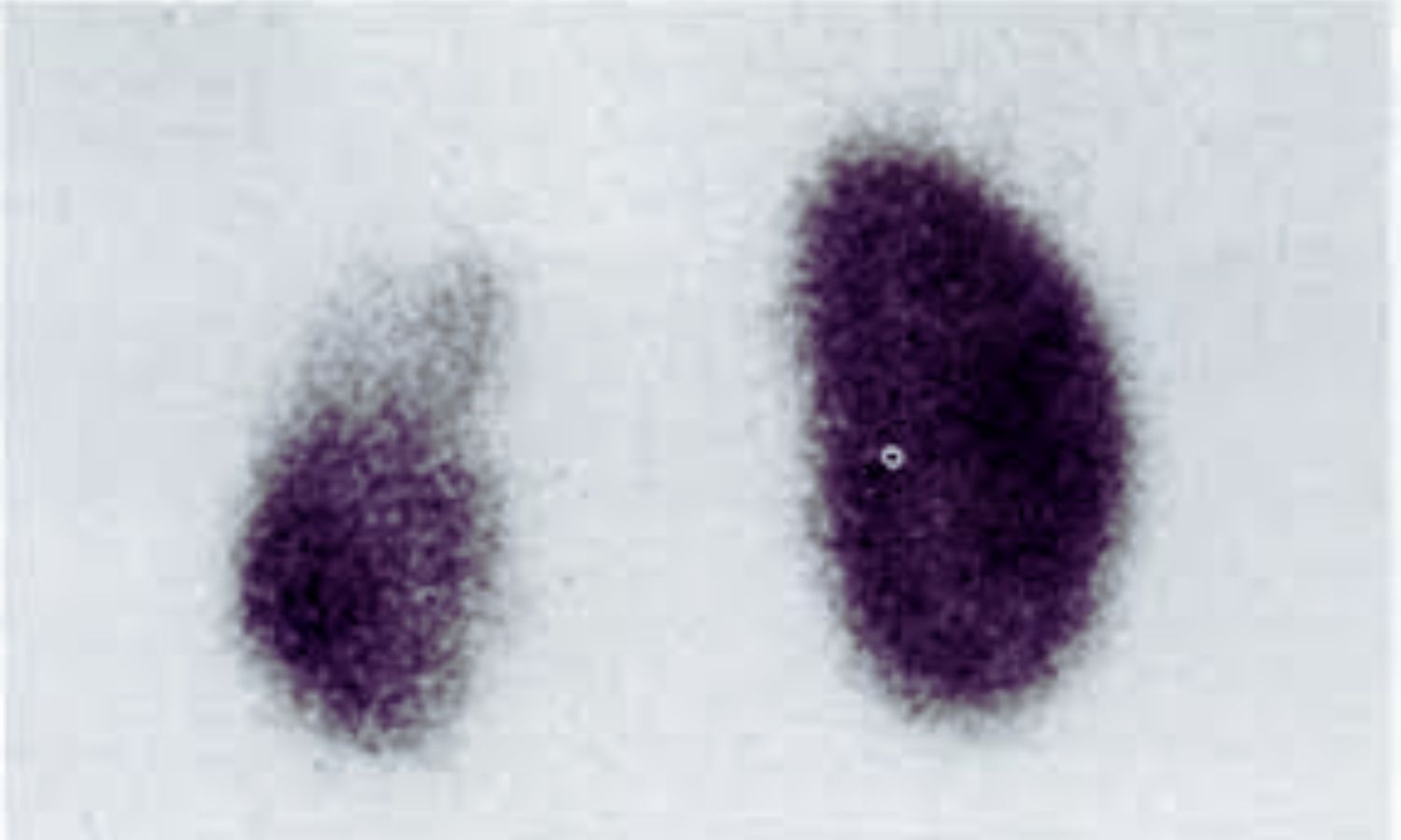 AI holds potential to differentiate between normal and abnormal kidneys ...