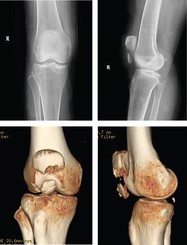 Suture reduction technique may reduce surgical time and surgical trauma ...