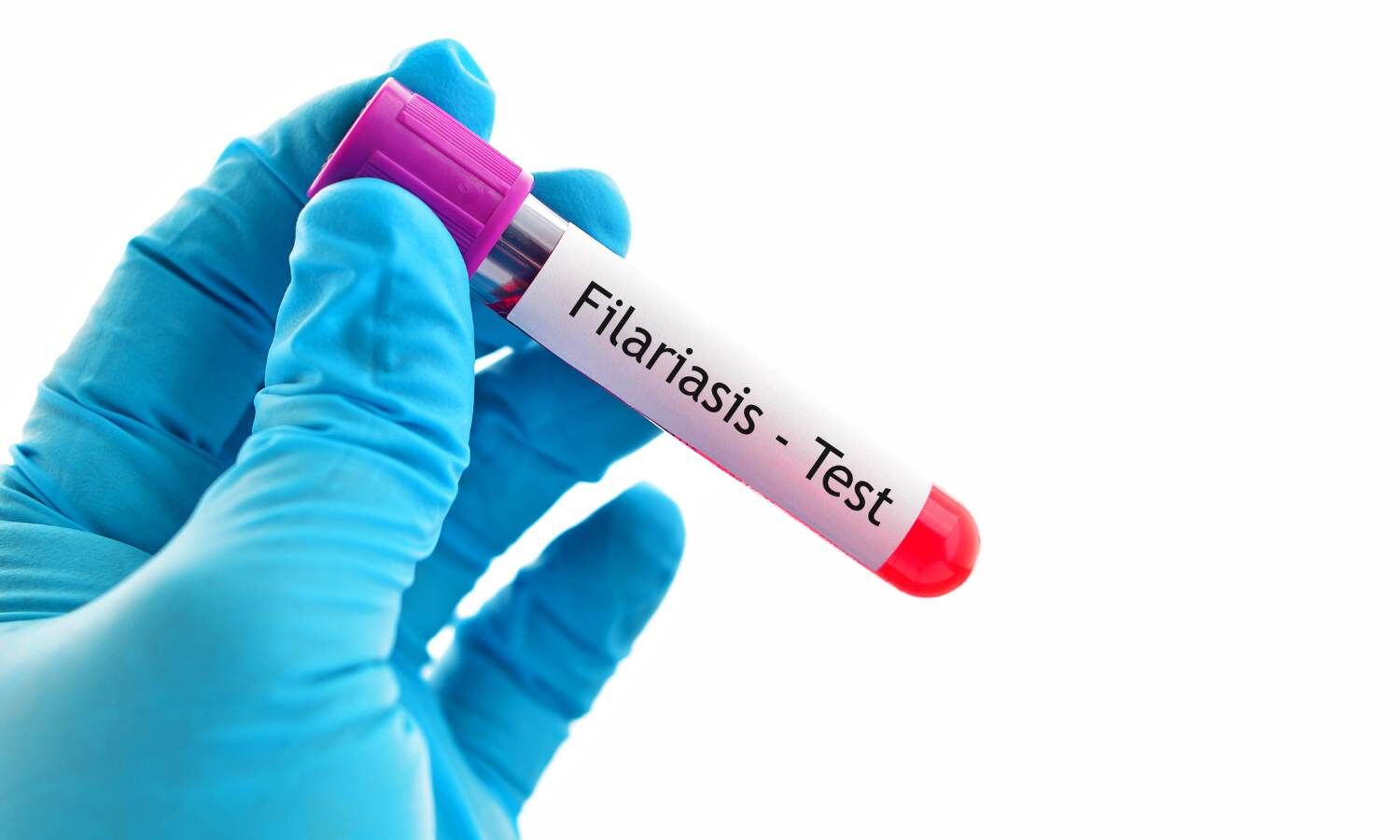 UP Govt urges people to take preventative medication against filariasis