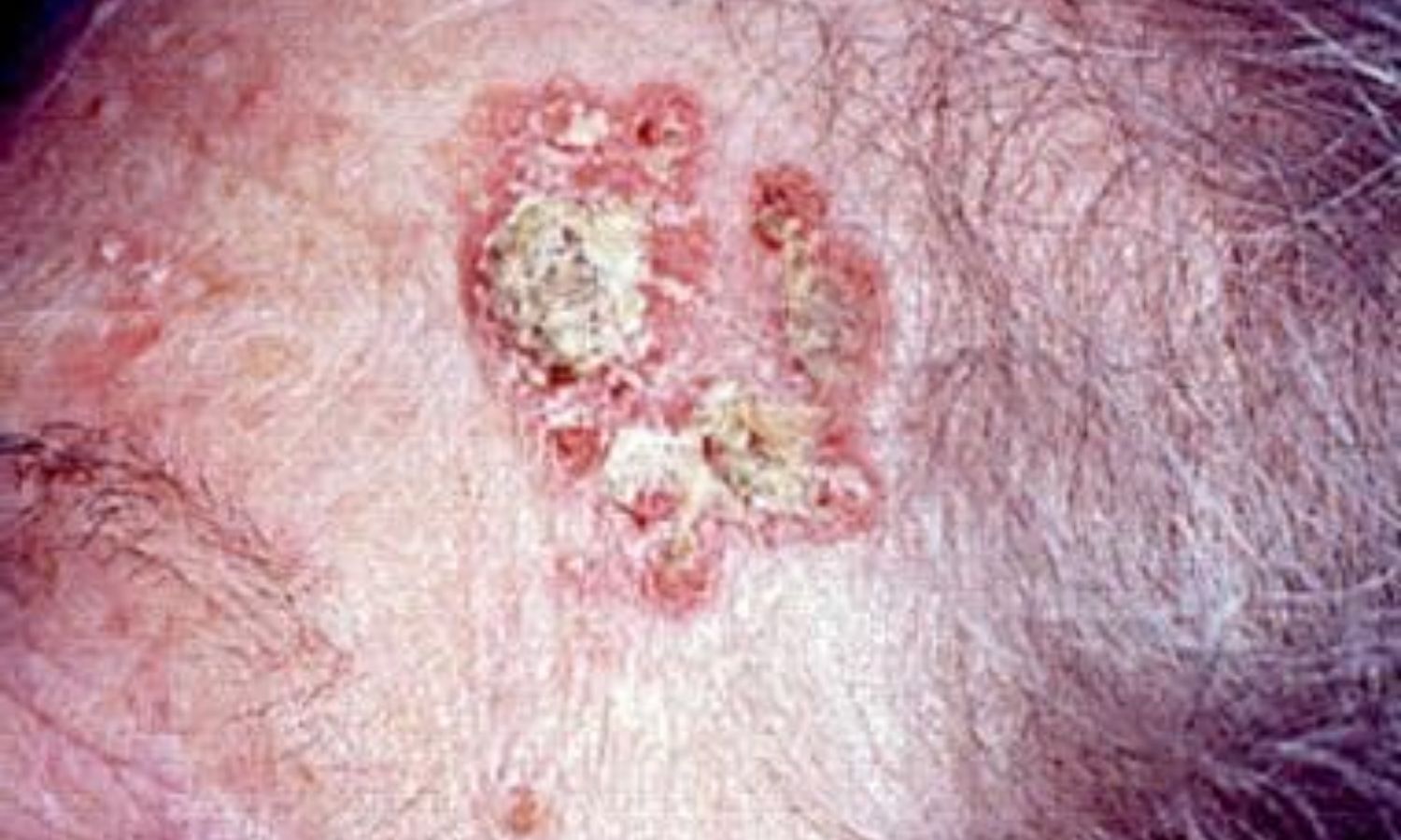 Daily use of 5-fluorouracil cream gives better cosmetic outcomes than ...