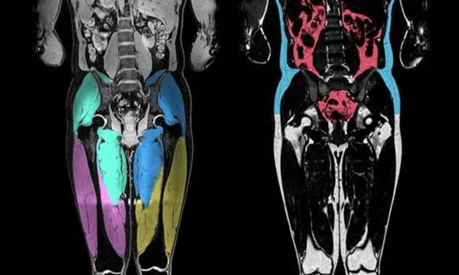 MRI effective for assessment of body composition in at-risk obese ...