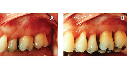 Calcium sodium phosphosilicate and arginine dentifrices reduce root ...