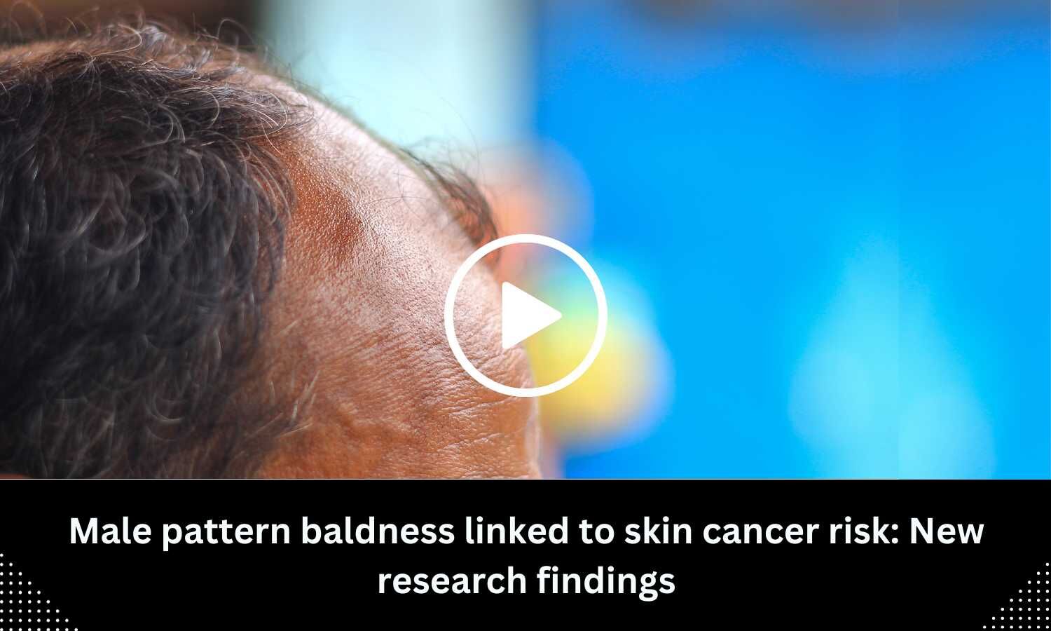 Male pattern baldness linked to skin cancer risk: New research findings