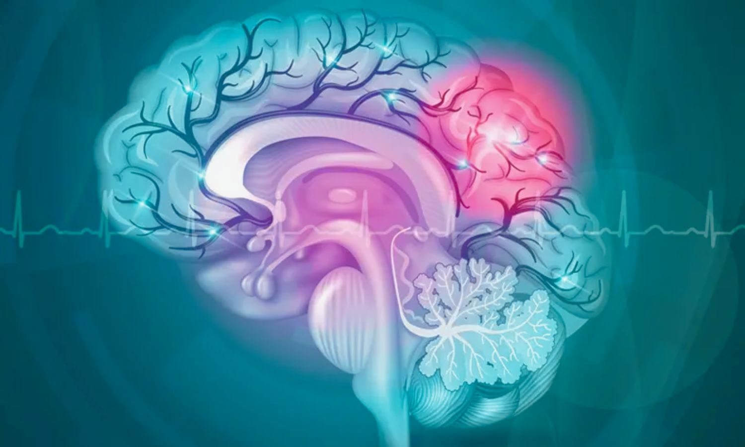 Optimum antithrombotic therapy for primary and secondary prevention of ...