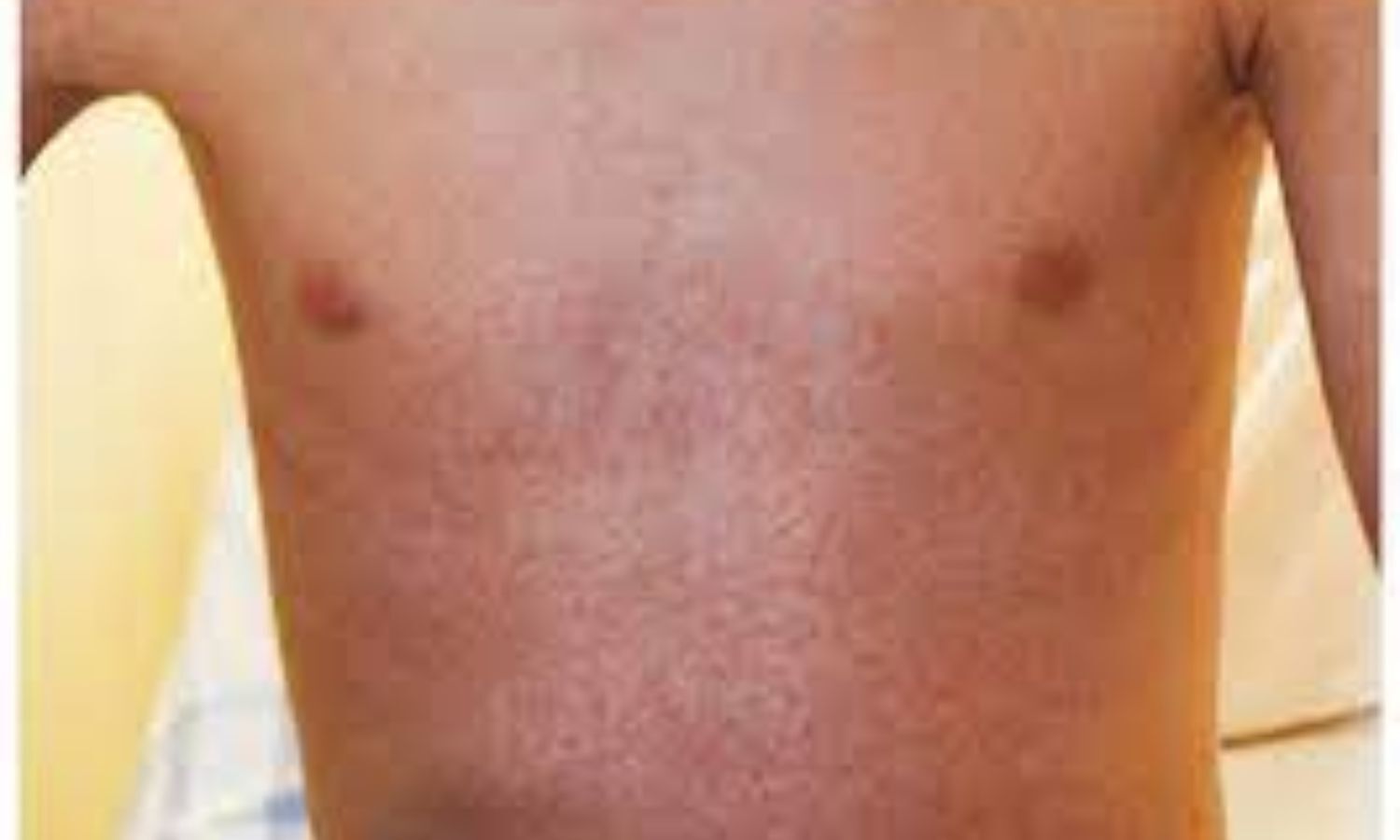 DRESS syndrome tied to high risk of complications in elderly, mainly ...