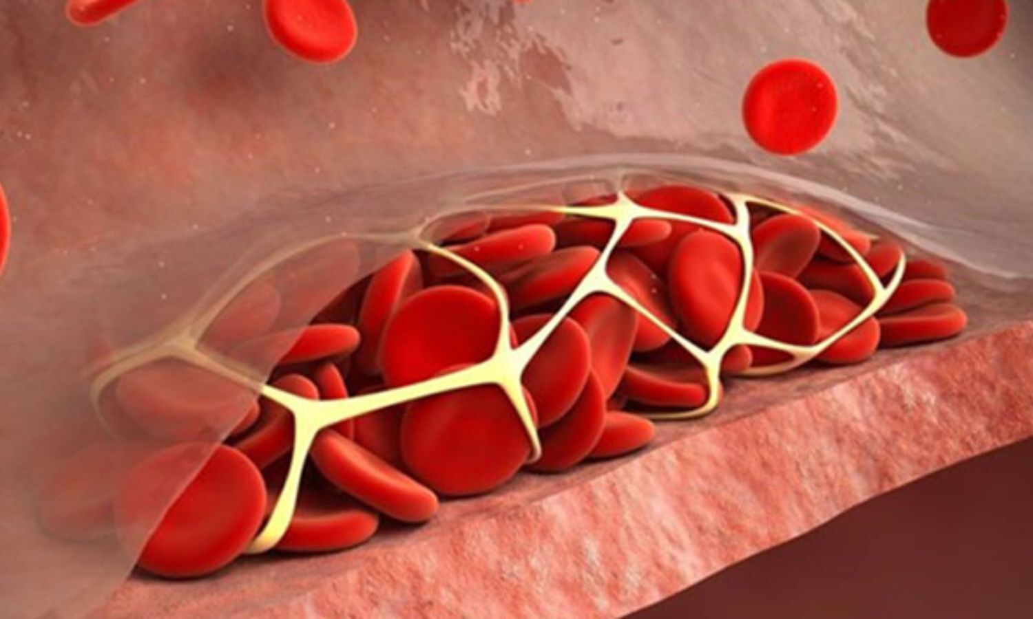 EMR-integrated model safe and effective in predicting hospital-acquired ...