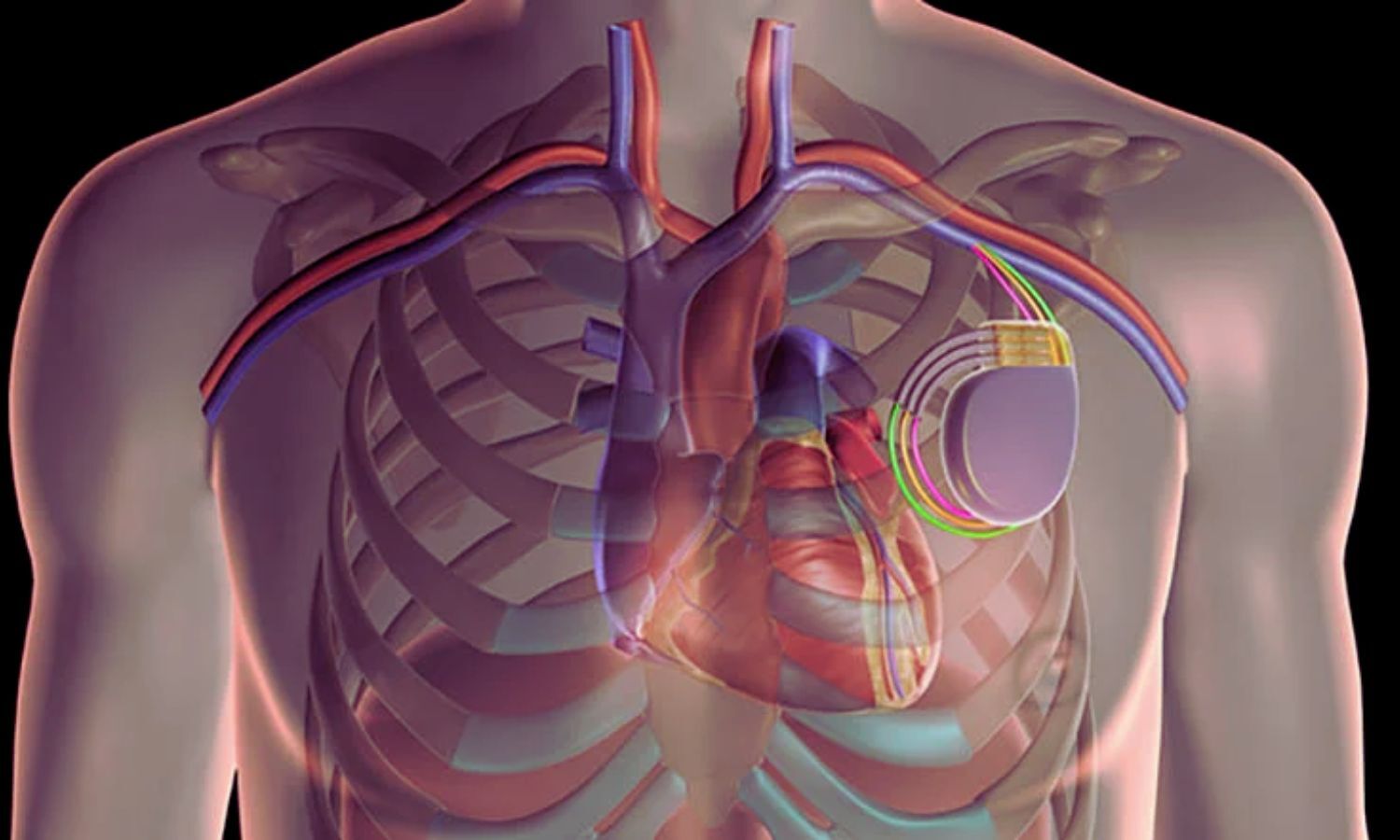 Adaptive CRT may not reduce HF decompensation or mortality versus ...