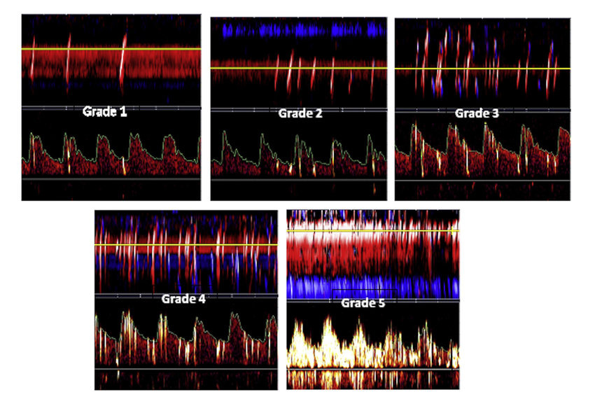 Transcranial Doppler very sensitive for detection of even smaller right ...