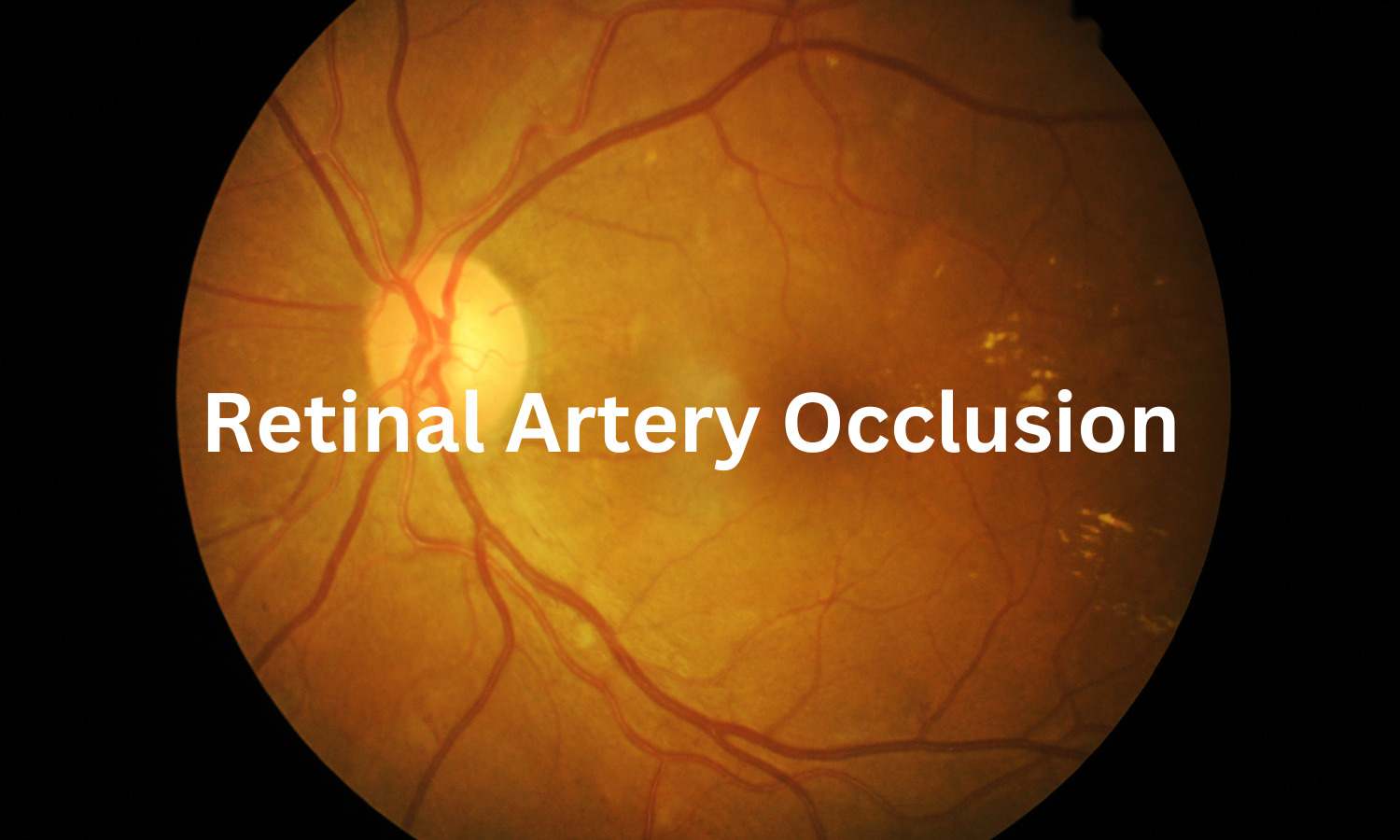 Higher risk of stroke, MI and death post Retinal Artery Occlusion: JAMA