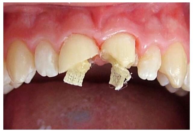 Compared to metal posts, prefabricated carbon and glass fiber posts may ...