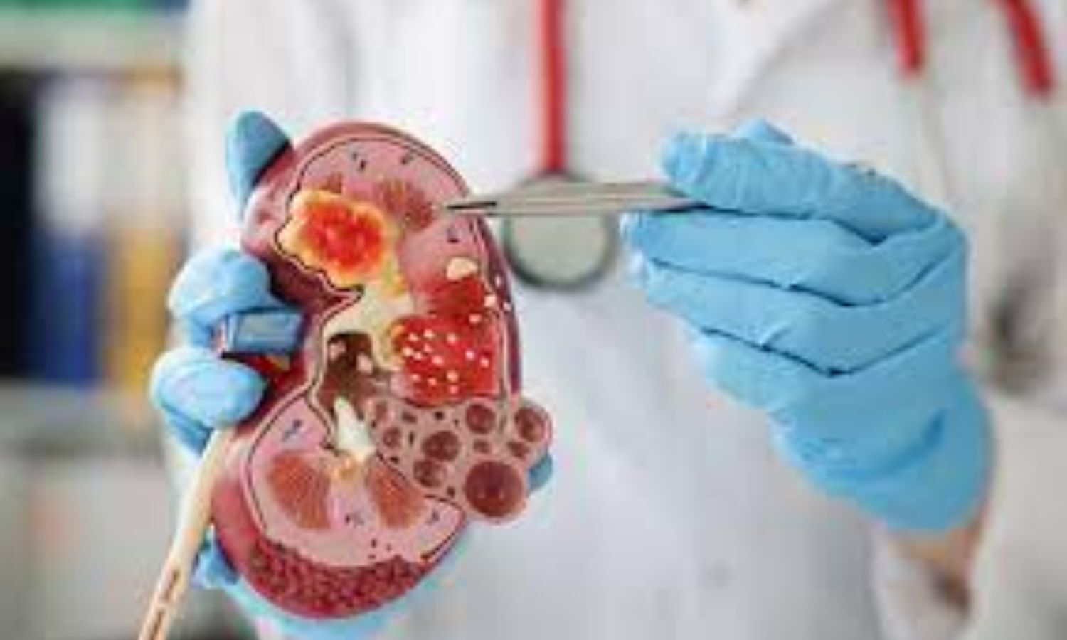 Endotracheal tube use helps maintain efficiency of Holmium lasers in ...