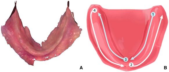 Two-step intraoral scans of edentulous mandibular arch may ...