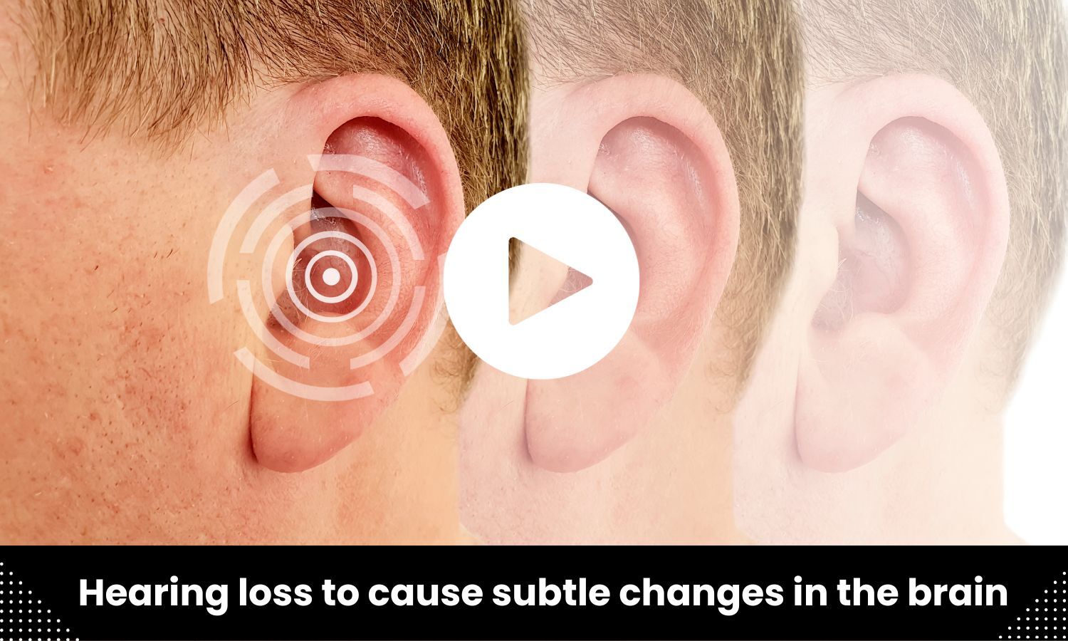 Hearing loss to cause subtle changes in the brain