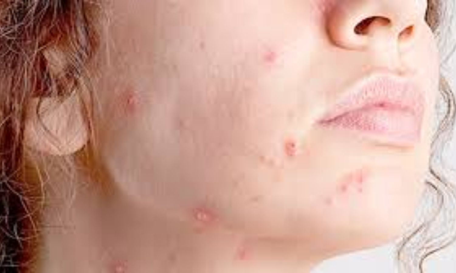 Use of calcium channel blockers linked to more severe actinic keratosis ...