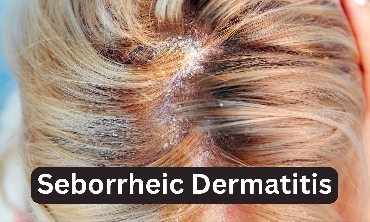 Study Reveals Two-Way Link Between Seborrheic Dermatitis and Other ...