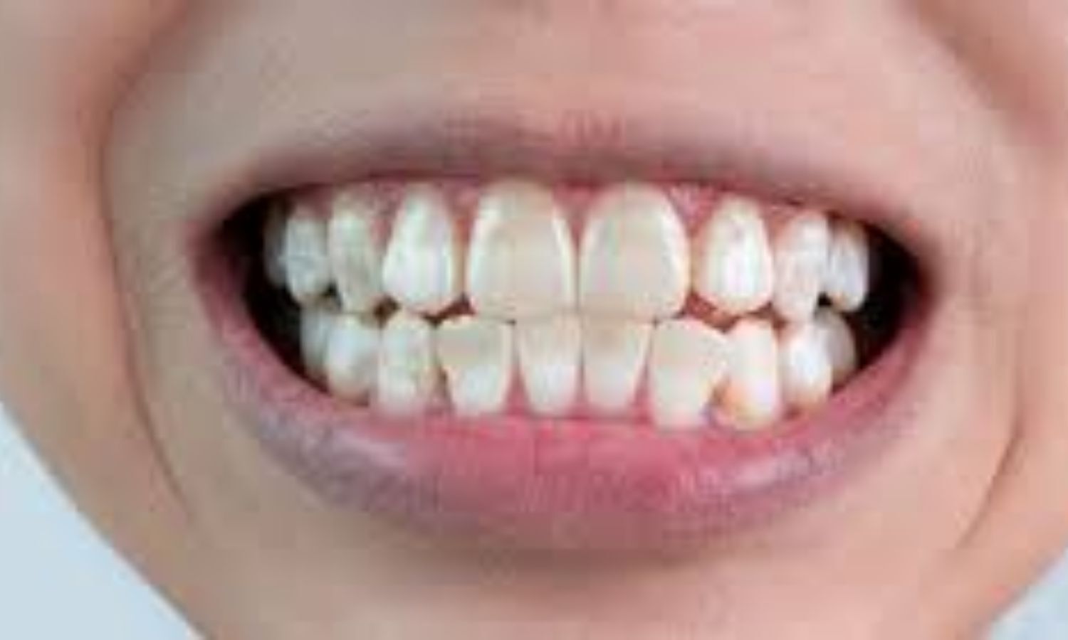 Dehydration affects shade of teeth and may look them whiter
