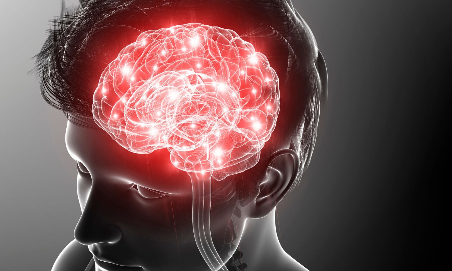 Patch technique using flow diverters effective in treating direct ...