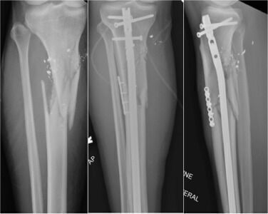 Plate-assisted reduction during intramedullary nailing of tibia shaft ...