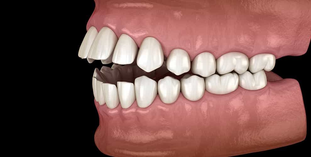 Clear aligners provide stable positive overbite in anterior open bite