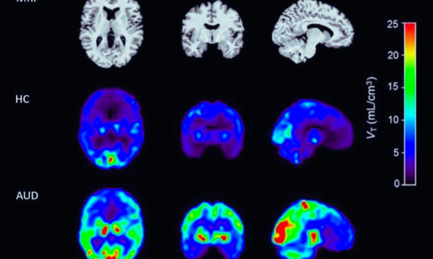 PET scans reveal key molecular driver of stress and addiction in people ...