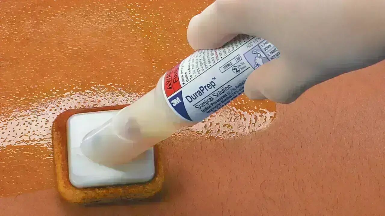 Iodine povacrylex in alcohol scores over chlorhexidine gluconate for ...