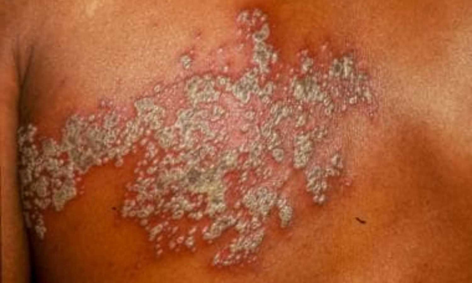 Crisugabalin Shows Significant Pain Reduction in Postherpetic Neuralgia ...