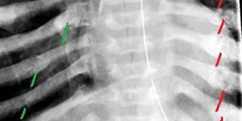 Fracture in number of ribs independent risk factor for venous ...