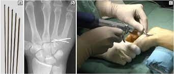 U-shaped Kirschner wire internal fixation safe and effective treatment ...