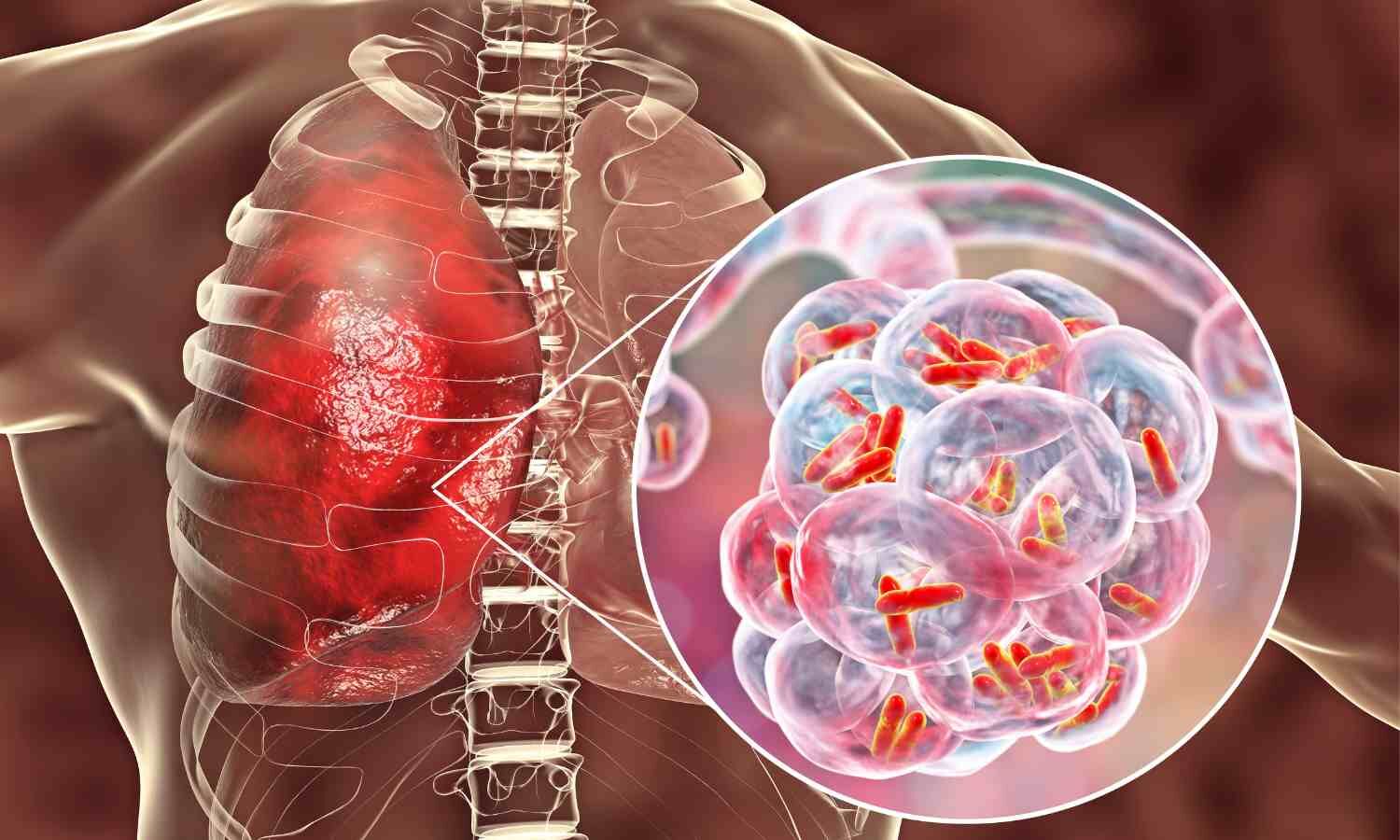 Ultra-low dose CT aids pneumonia diagnosis in immunocompromised ...