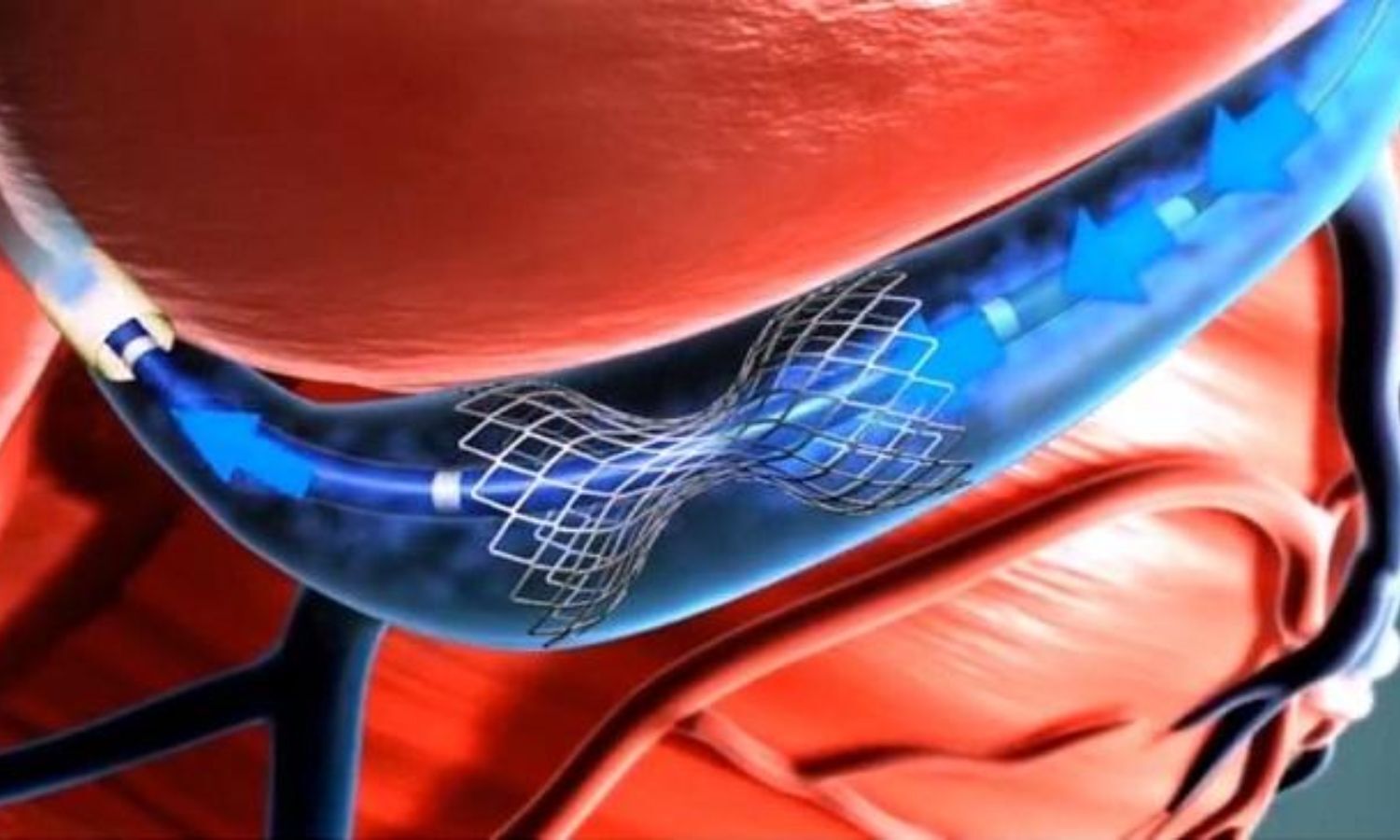 Coronary sinus reducer improves symptoms in patients with refractory ...