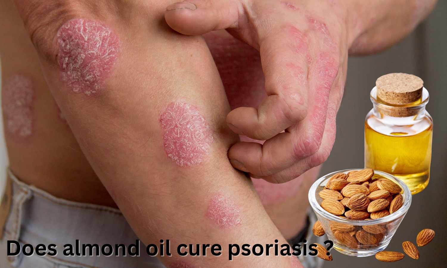 Fact Check: Does almond oil cure Psoriasis?