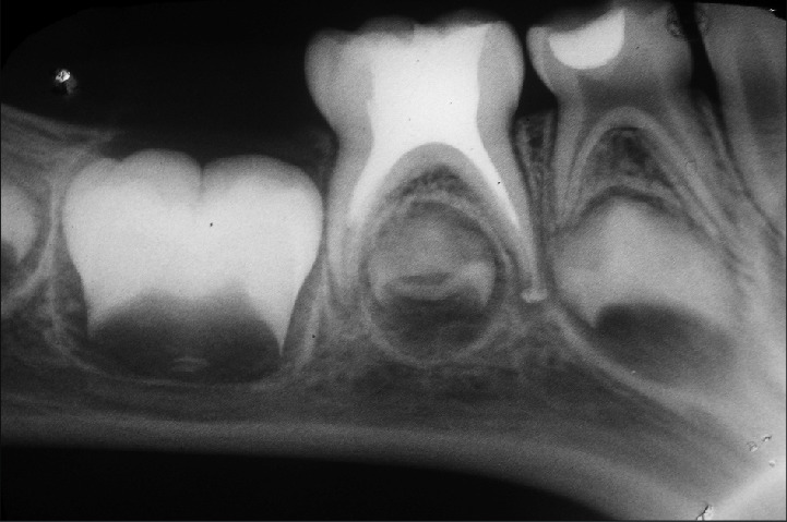 Cone-beam computed tomography superior to periapical radiography for ...