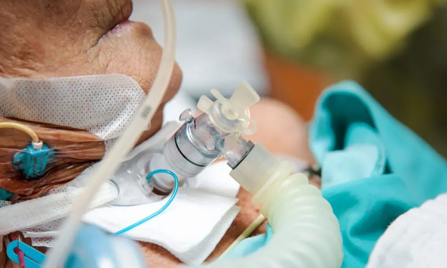Swallowing ability crucial for decannulation of tracheostomy in ...