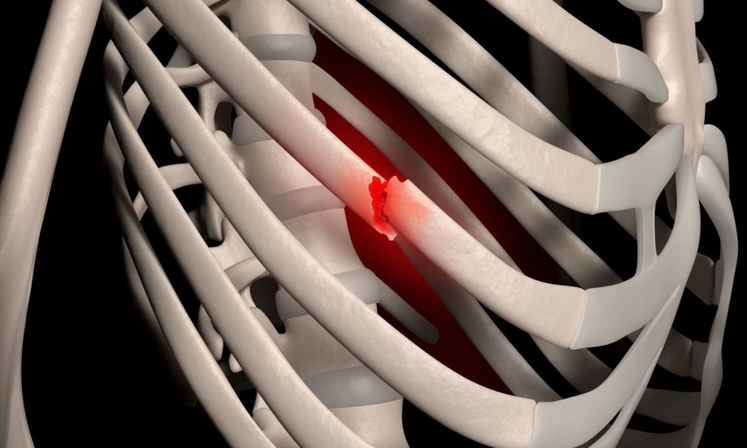 Freezing Pain Away after rib fracture: Cryoneurolysis for Lasting ...