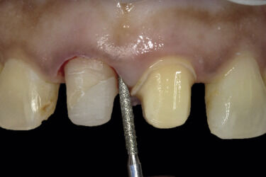 Use of restorations on vertically prepared teeth suitable option to ...