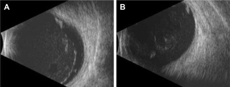 B scan US and eye-steering UWFI combo useful tool for retinal tear ...