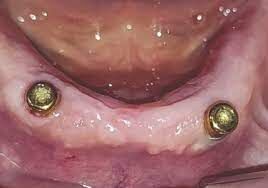 Laser bio-stimulation may enhance soft and hard peri implant tissues ...