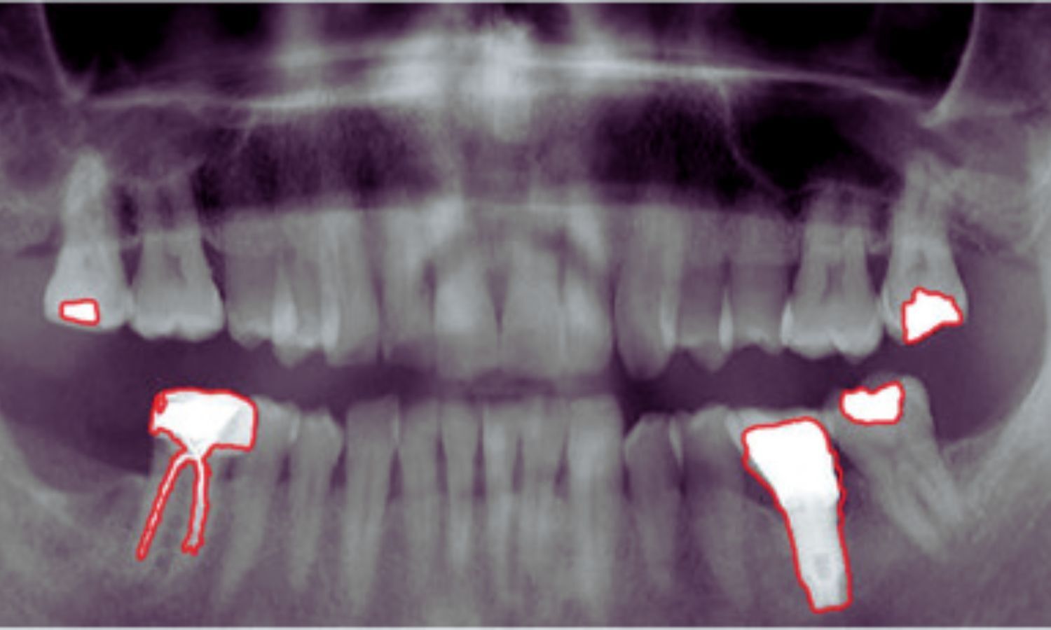 AI Pilot Study Revolutionizes Pulp Stone Detection in Panoramic ...