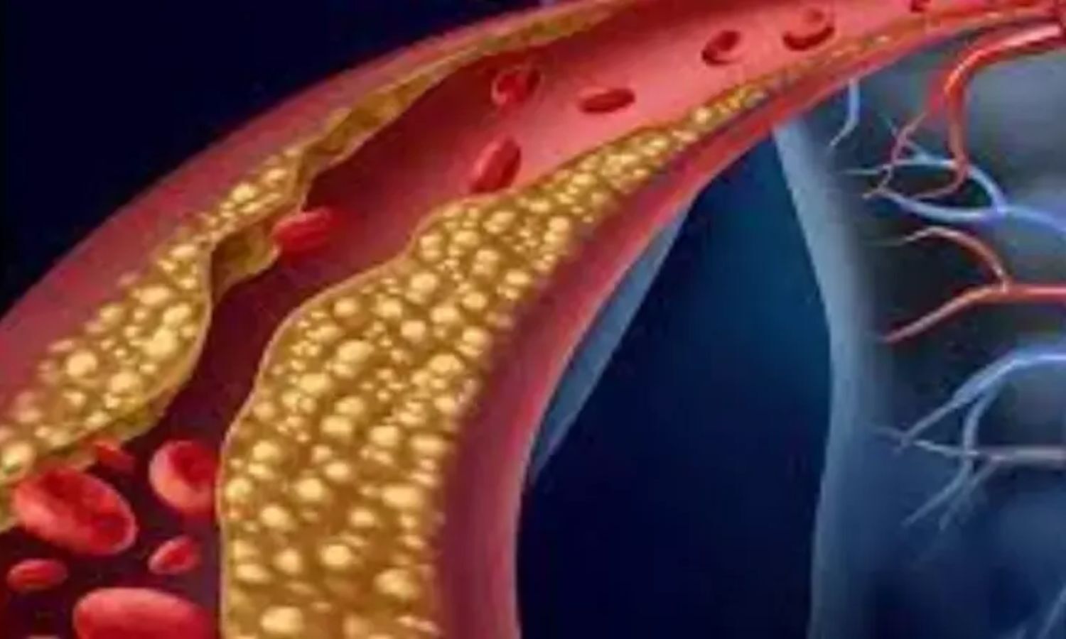 Plozasiran: Groundbreaking RNA Interference Agent Targets APOC3 for ...