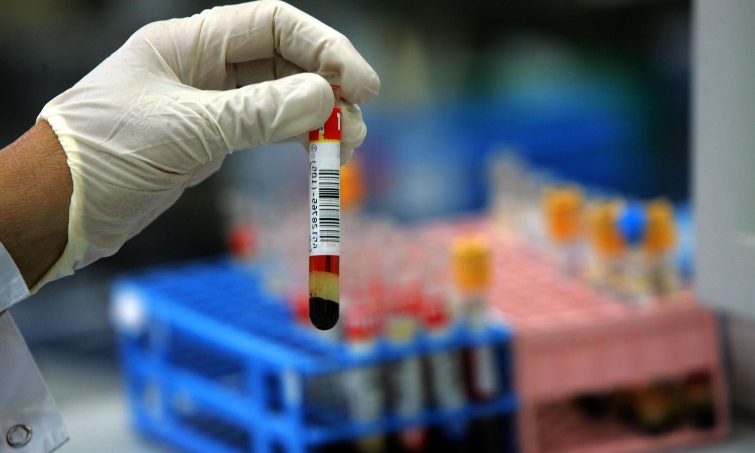 Red Blood Cell Distribution Width to Albumin Level Ratio Linked to ...