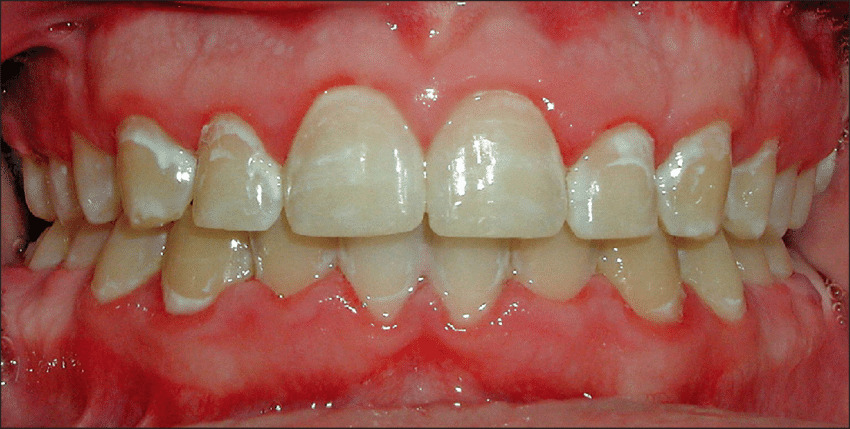 Incidence of White spot lesions high in adolescents undergoing clear ...