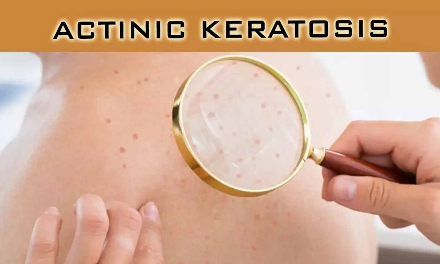 Half-Light Dose BF-200 ALA PDT Promising for Severe Actinic Keratosis ...