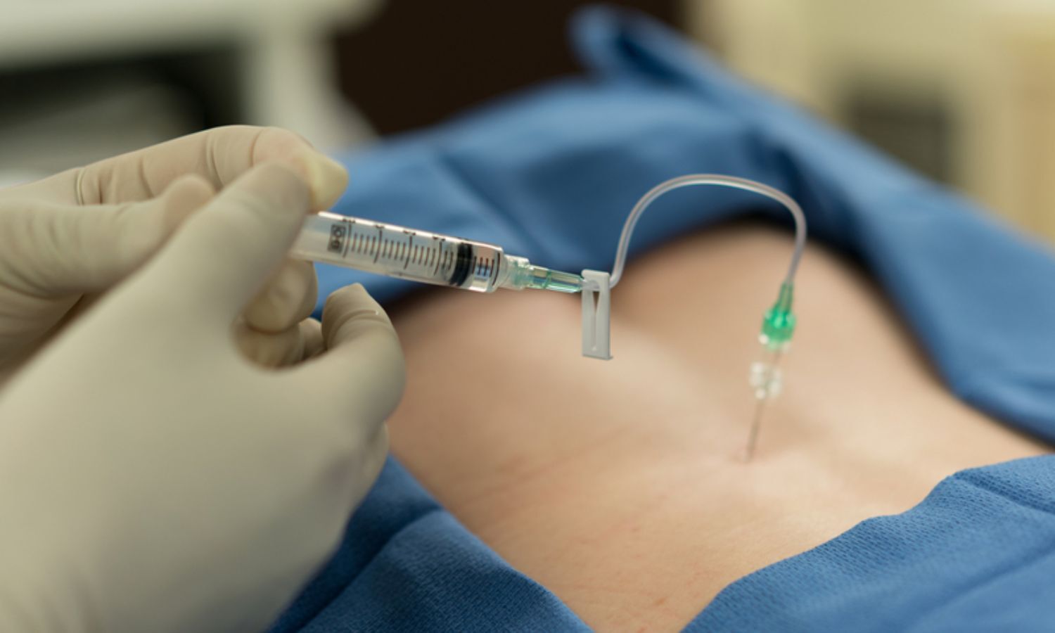 Dezocine PCEA Effectivey controls Pain and Improves Patient Outcomes in ...