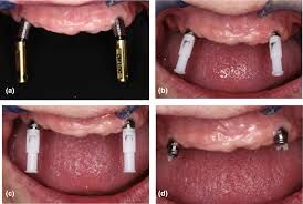 Two narrow-diameter titanium-zirconium implants with stud-attachments ...