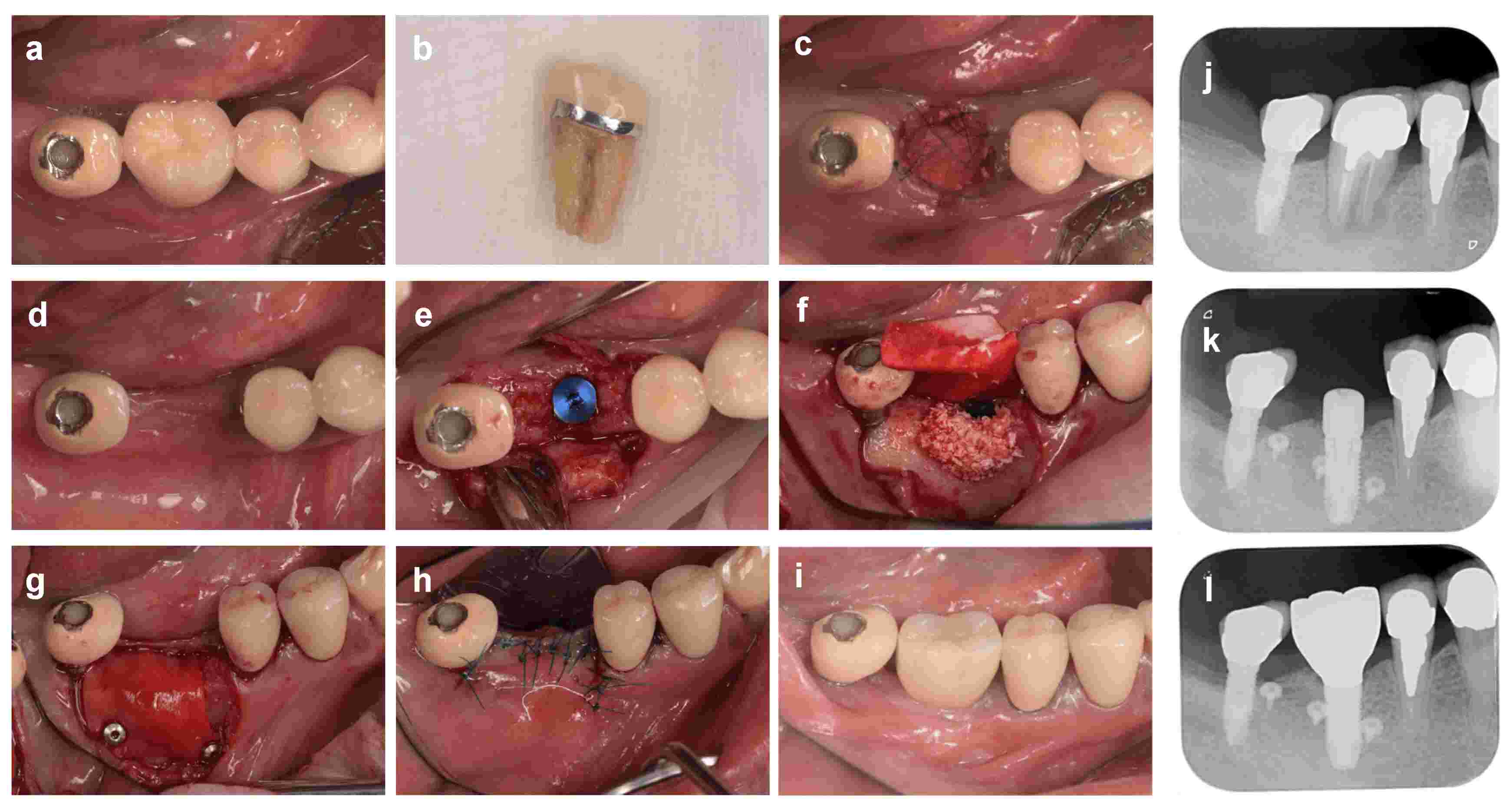 Alveolar ridge preservation after extraction may obviate need for ...