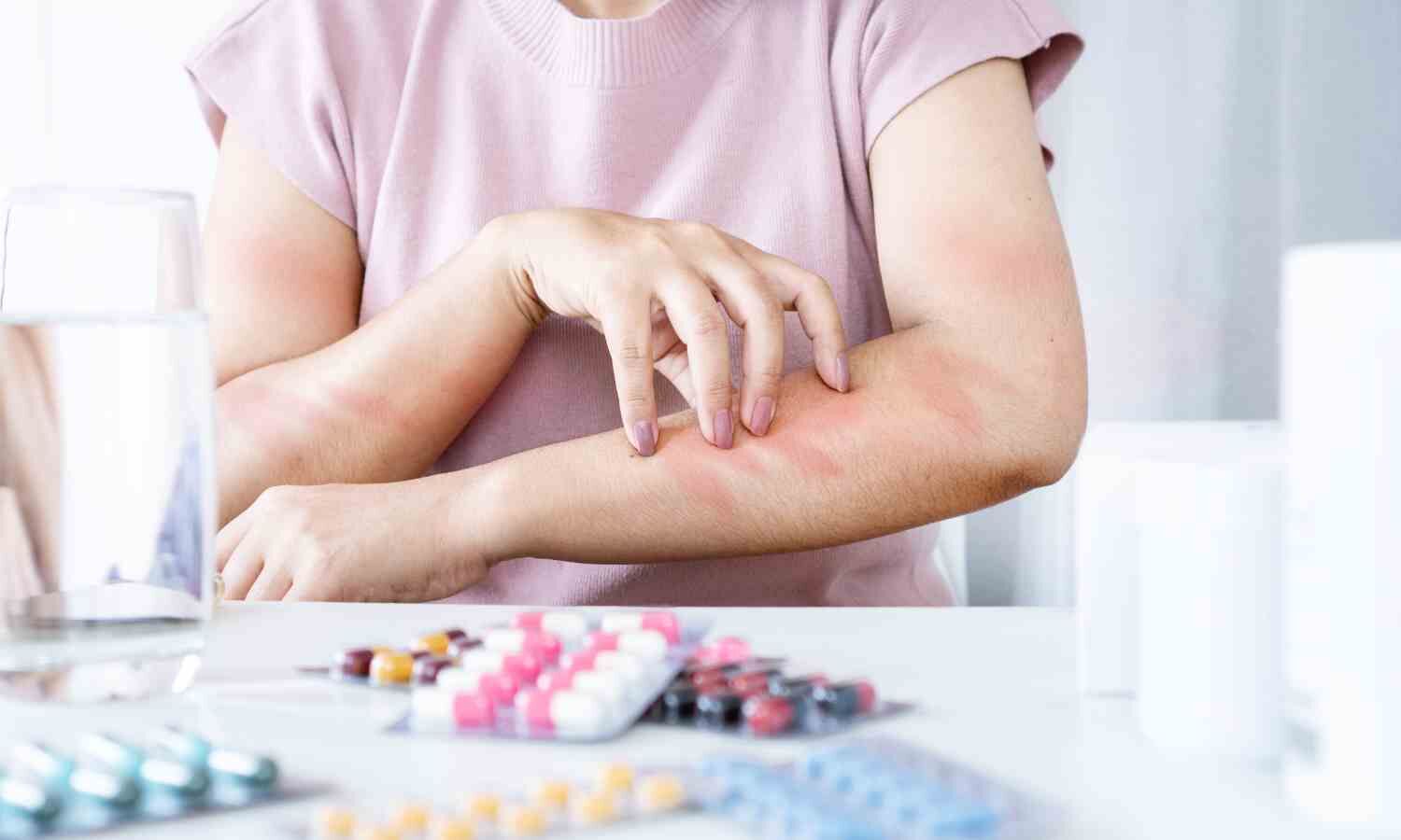 Oral Antibiotics Tied to Higher Risk of Serious Skin Reactions ...