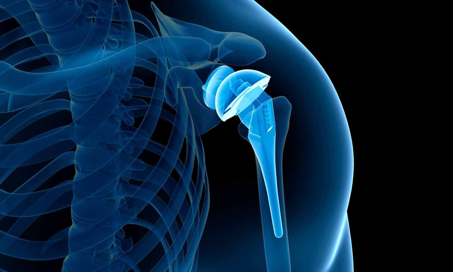 Novel shoulder arthroplasty Surgery Utilizing Groundbreaking Mixed ...