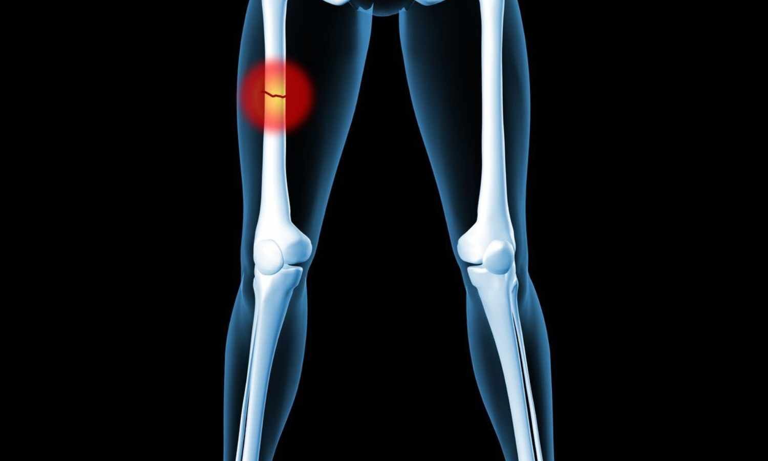 Unique Case of Accelerated Bone Growth Precipitating a One-Stage ...